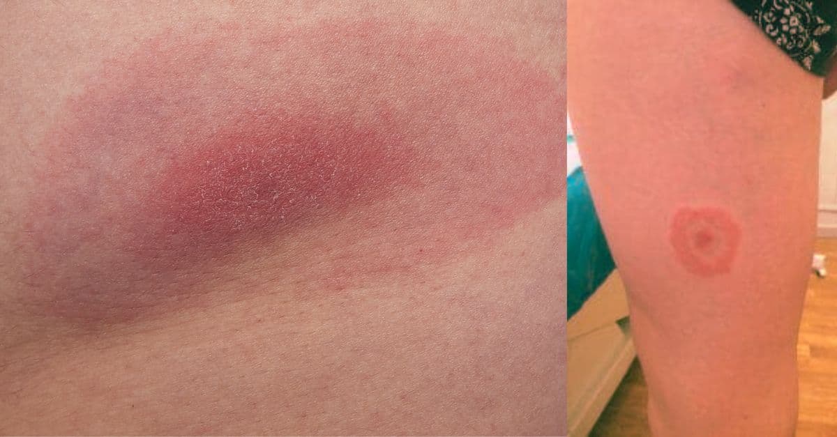 Tick Bite in Italy | Doctorsa